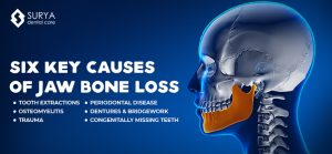 6 Possible causes of jaw bone loss